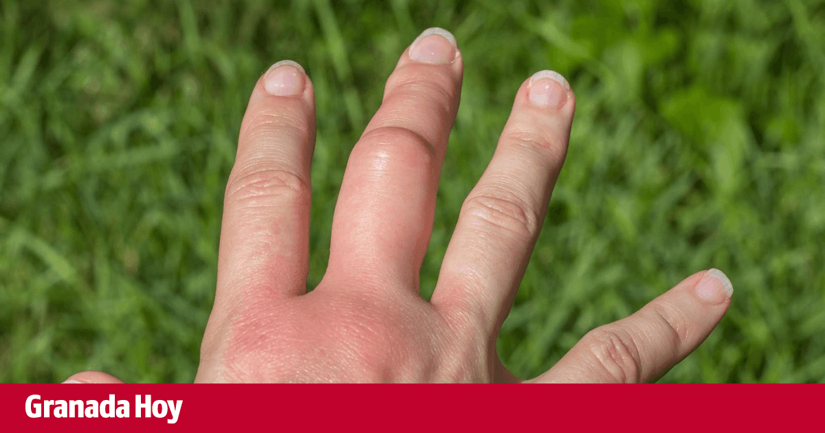 Síndrome de Skeeter: la severa reacción a las picaduras de mosquito que se confunde con otras ...