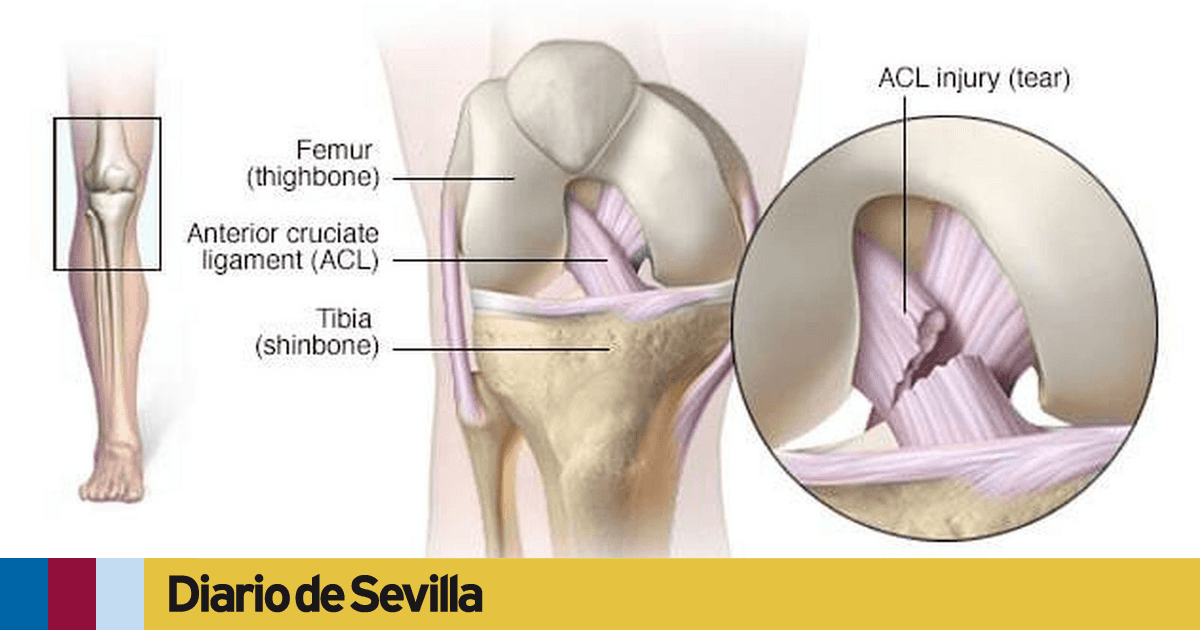 ¿Cuánto tarda en recuperarse una rotura de ligamento?
