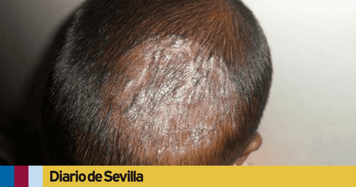 Alertan de un brote de tiña detectado en peluquerías de toda España