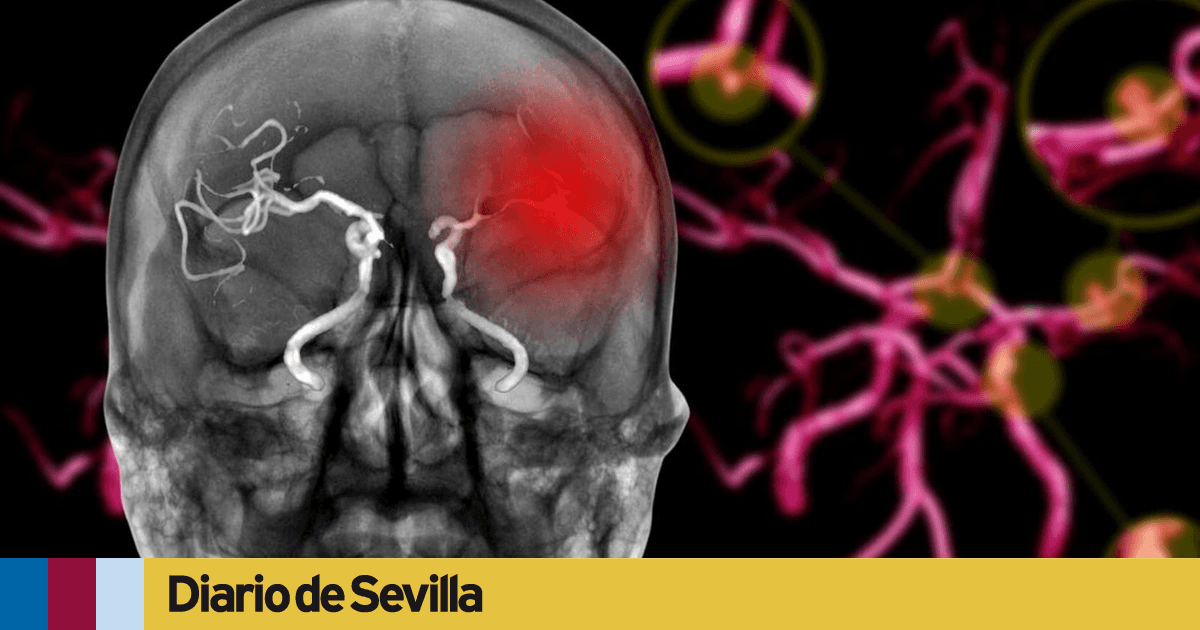 Aneurisma cerebral: estos son los síntomas que nos ponen en alerta