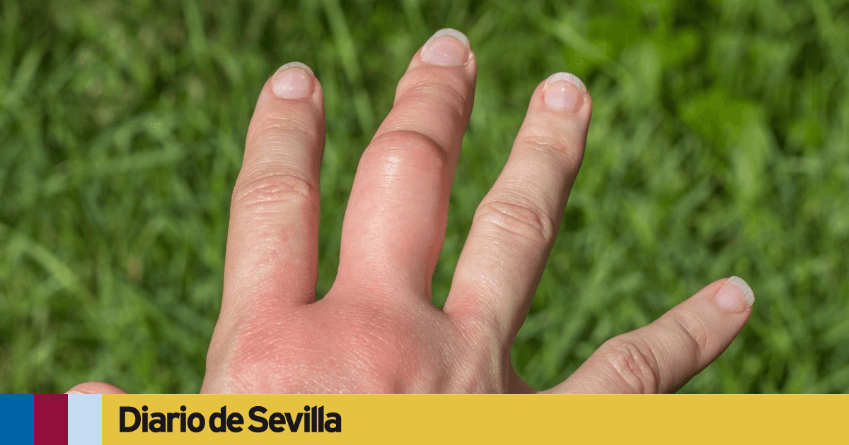 Síndrome de Skeeter: la severa reacción a las picaduras de mosquito que ...