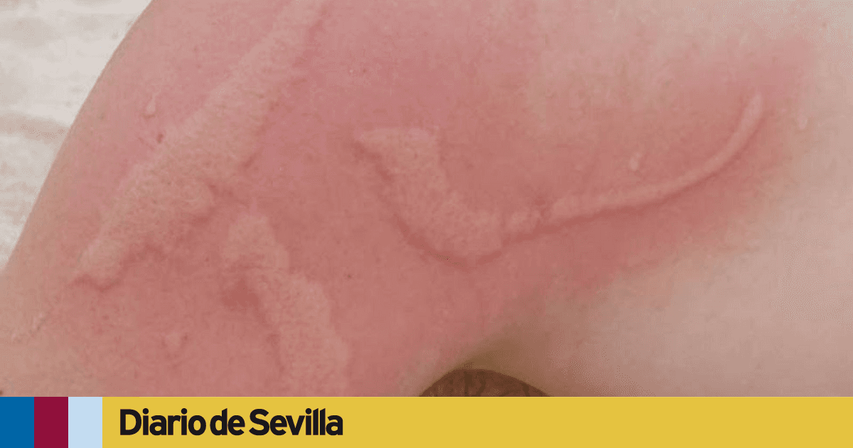 Cómo actuar ante la picadura de una medusa