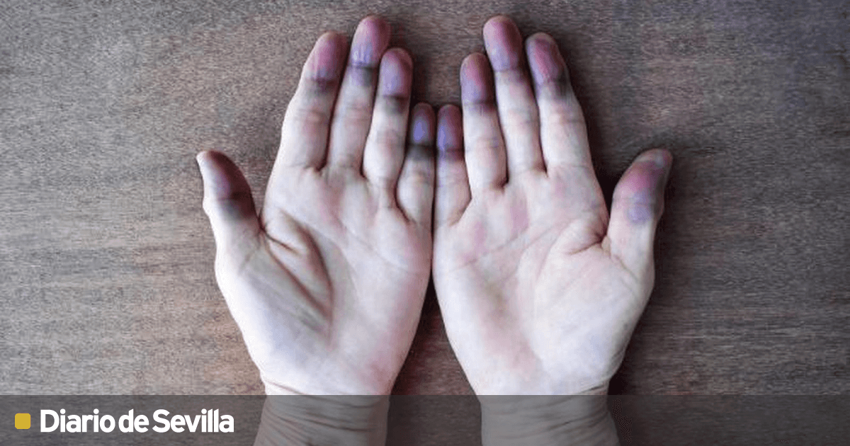 En qué consiste la cianosis, el síntoma de una enfermedad que está ...